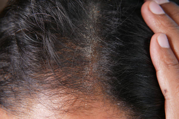 Tengo escamas en el cuero cabelludo que pican y se me cae el pelo ¿Cómo ...